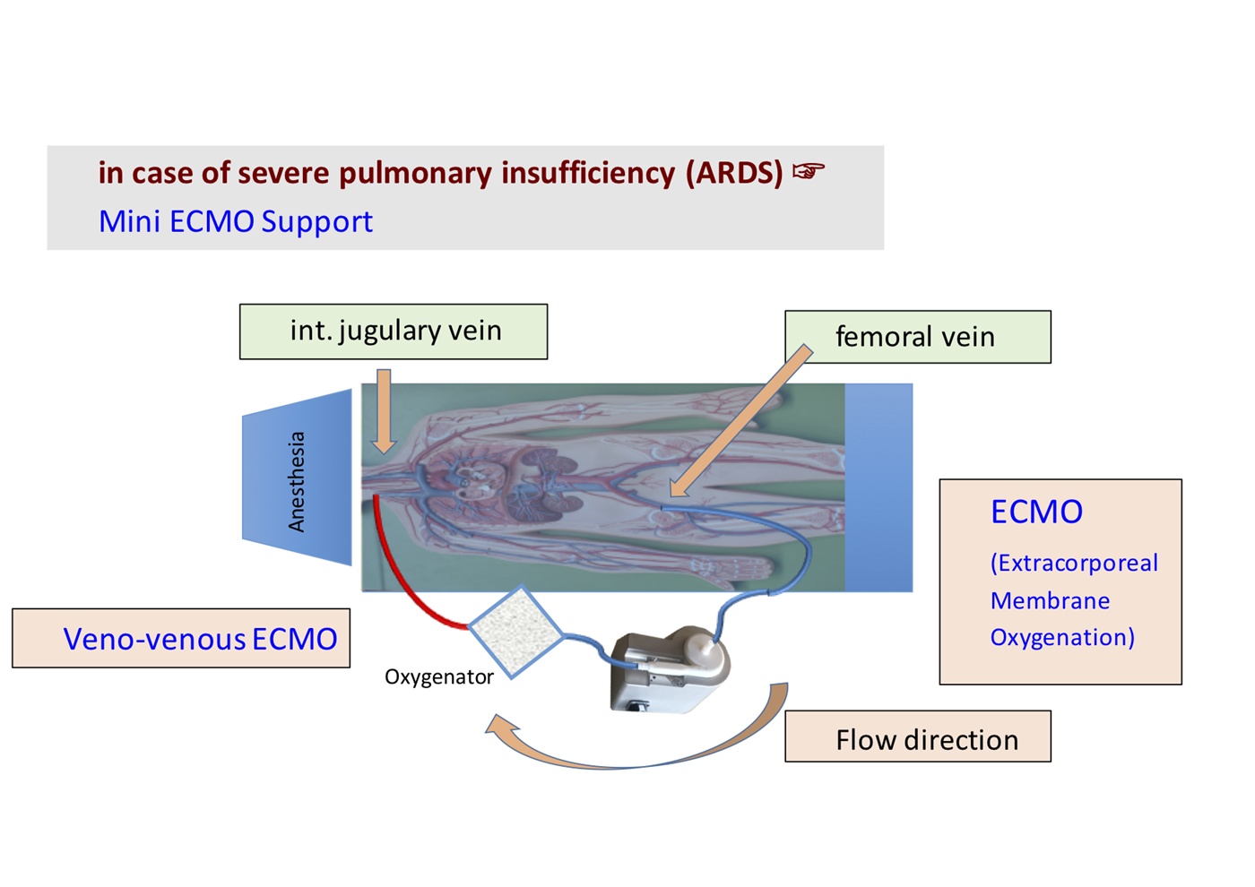 Covid19 – IASP Mini veno-venous ECMO device in the acute pulmonary ...
